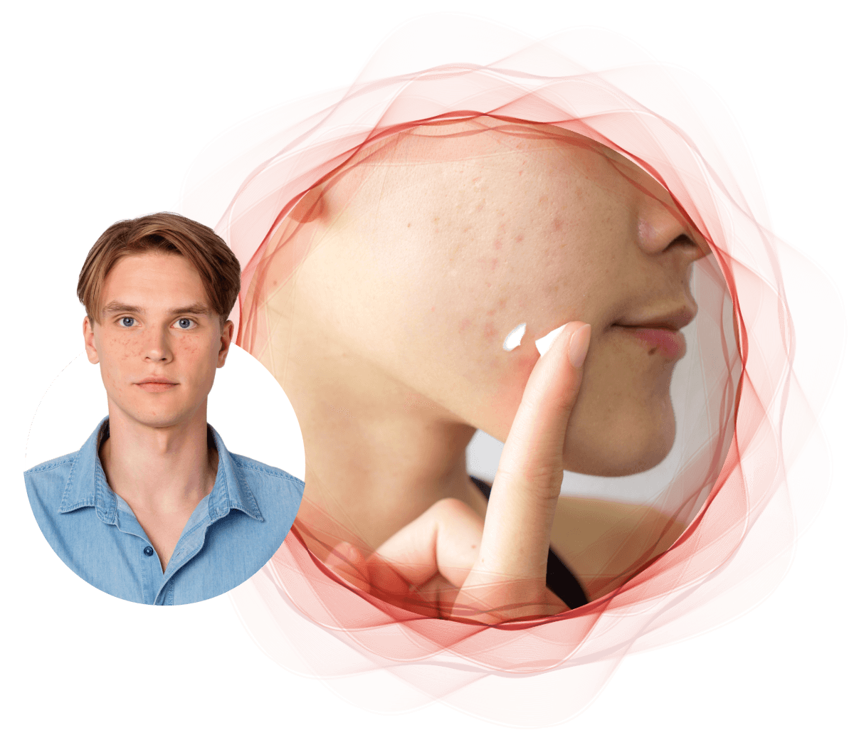 AcneTest - Fagron Genomics US